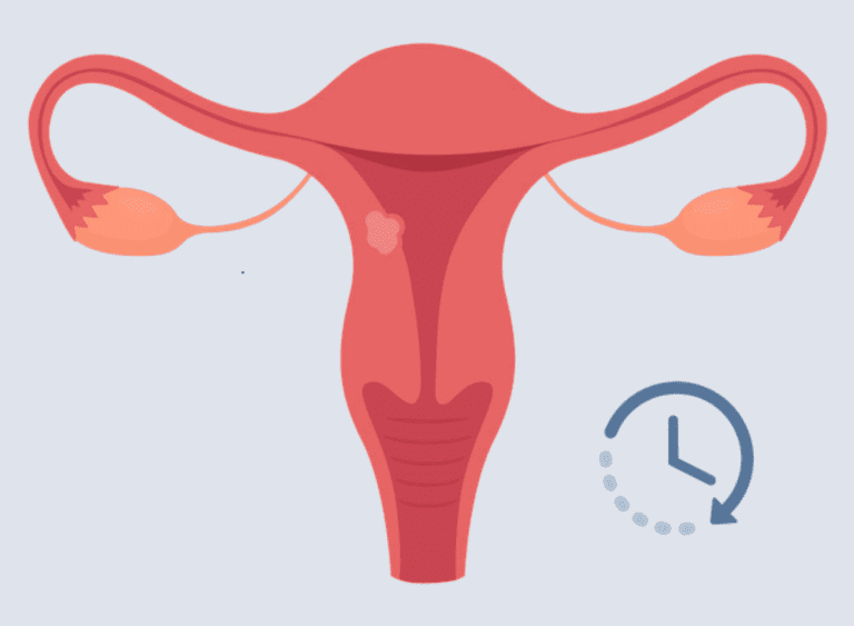 Sonata® Transcervical Fibroid Ablation - Hologic
